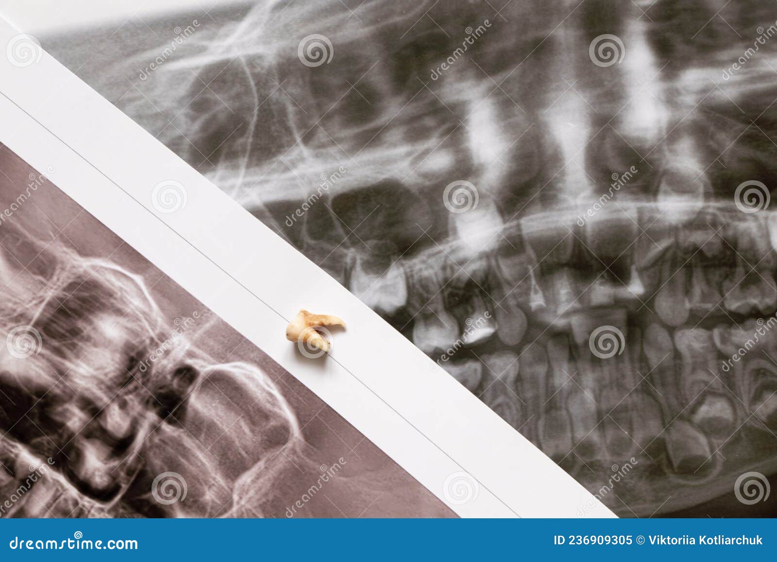 A Panoramic Image Shows Several Embedded and Impacted Teeth As on the ...