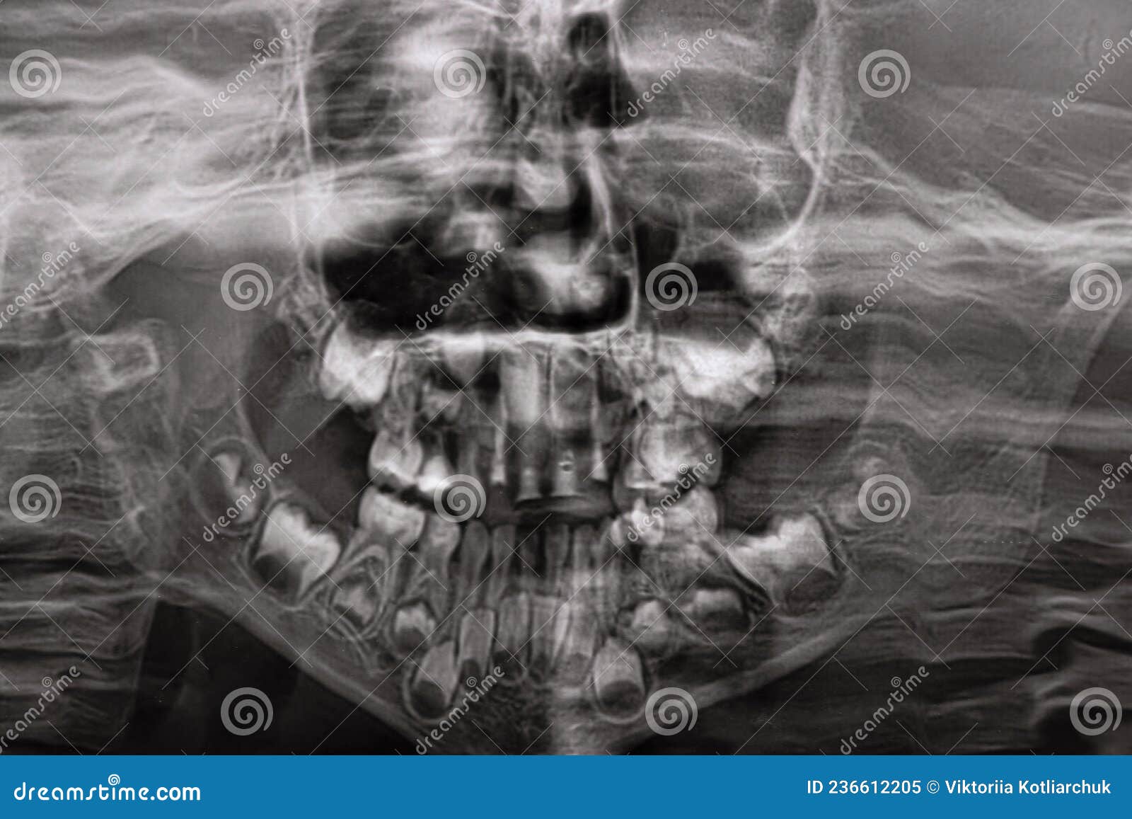 The Panoramic Image Shows Several Embedded and Impacted Teeth in Both ...