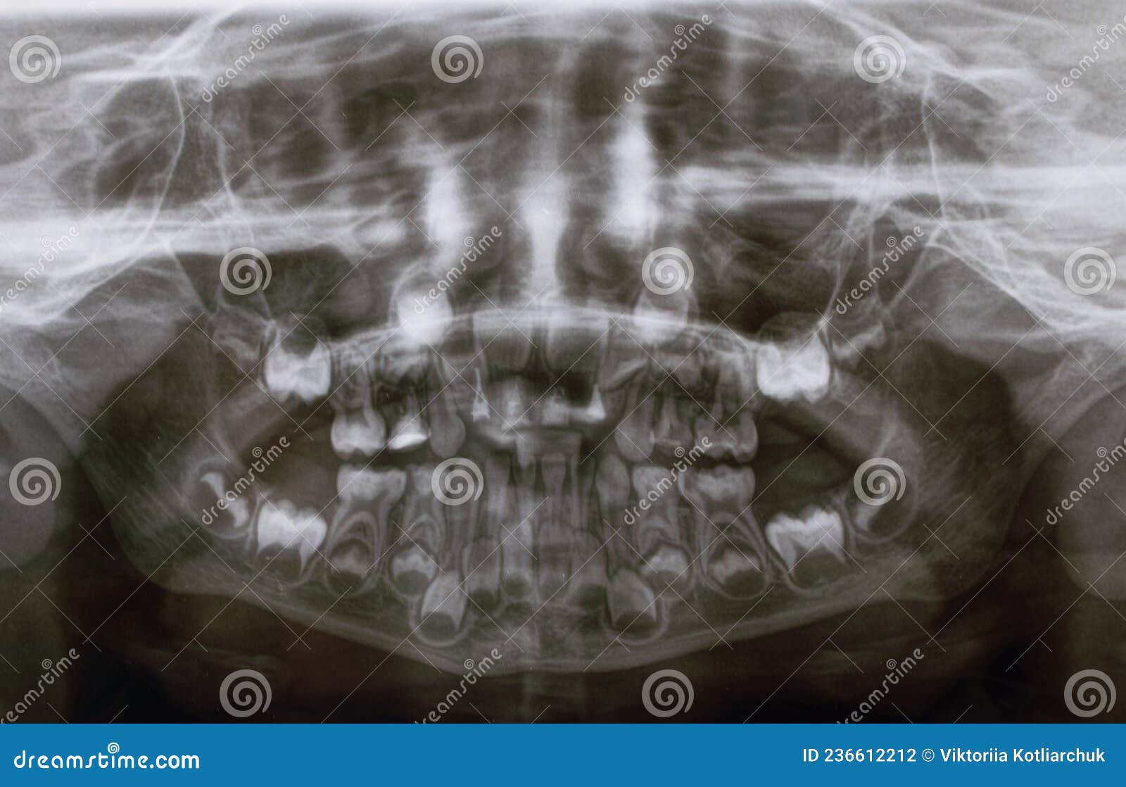 The Panoramic Image Shows Several Embedded and Impacted Teeth in Both ...
