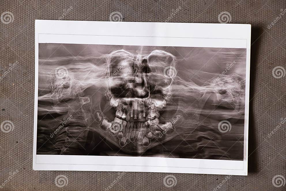 The Panoramic Image Shows Several Embedded and Impacted Teeth in Both ...