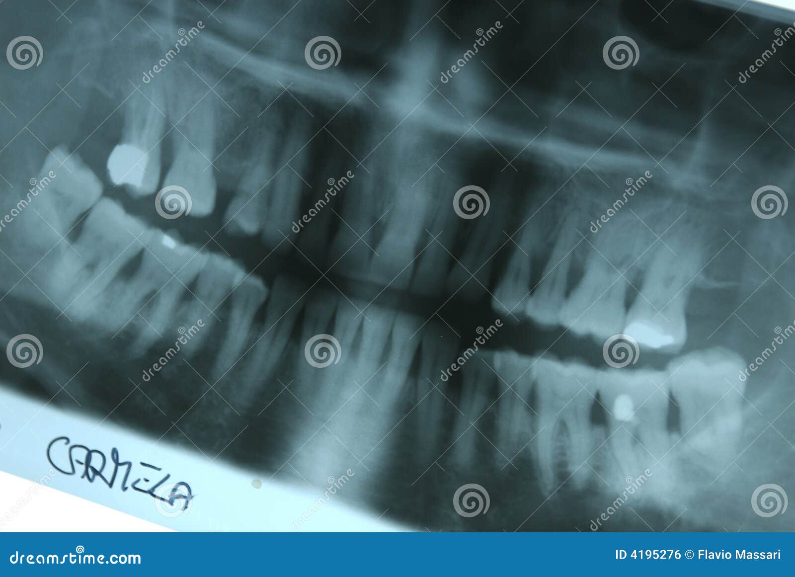 Panoramic Radiography of Mouth Stock Photo - Image of expertise ...