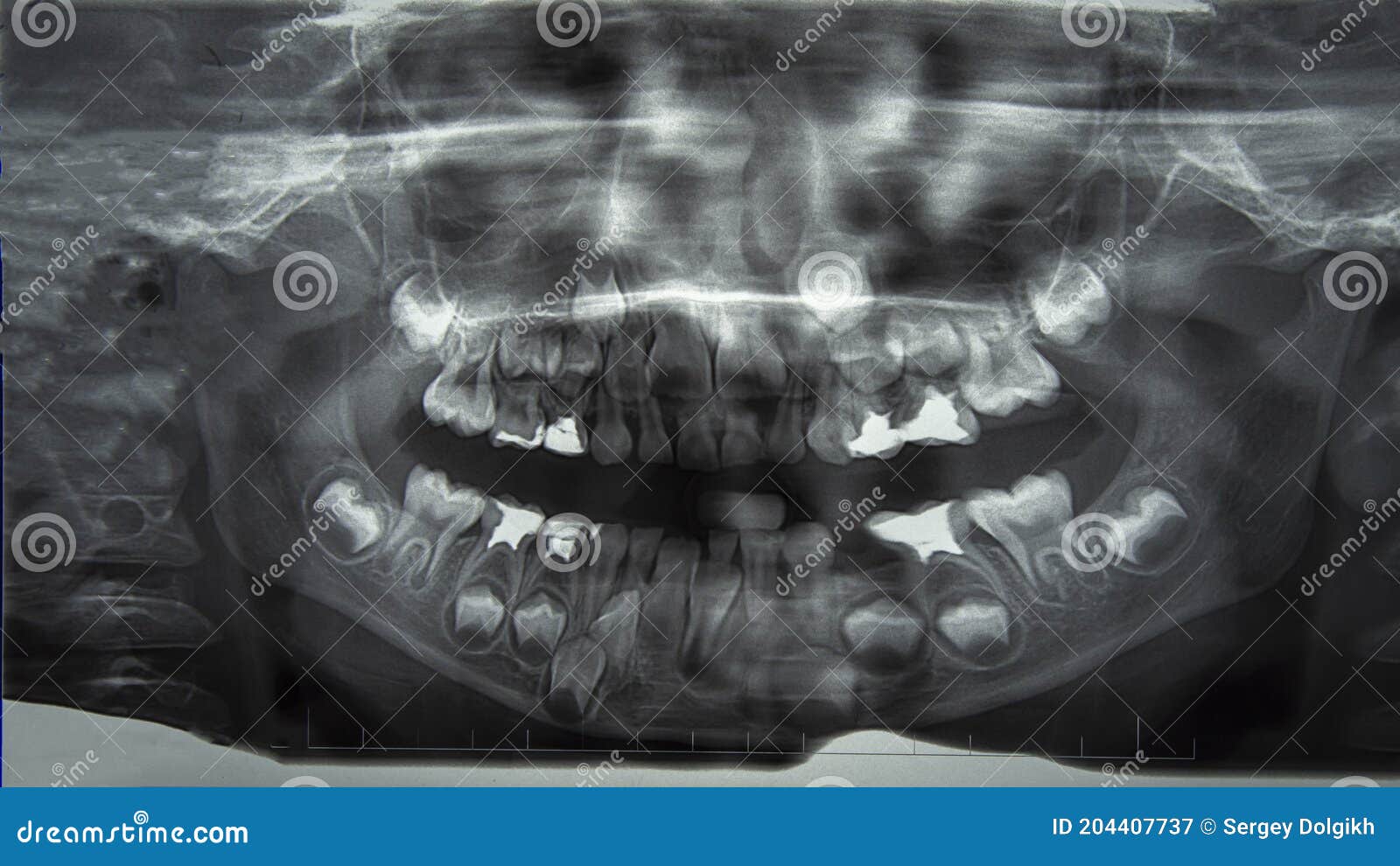 Panoramic X-ray of a Child`s Upper and Lower Jaw Teeth with Damaged ...