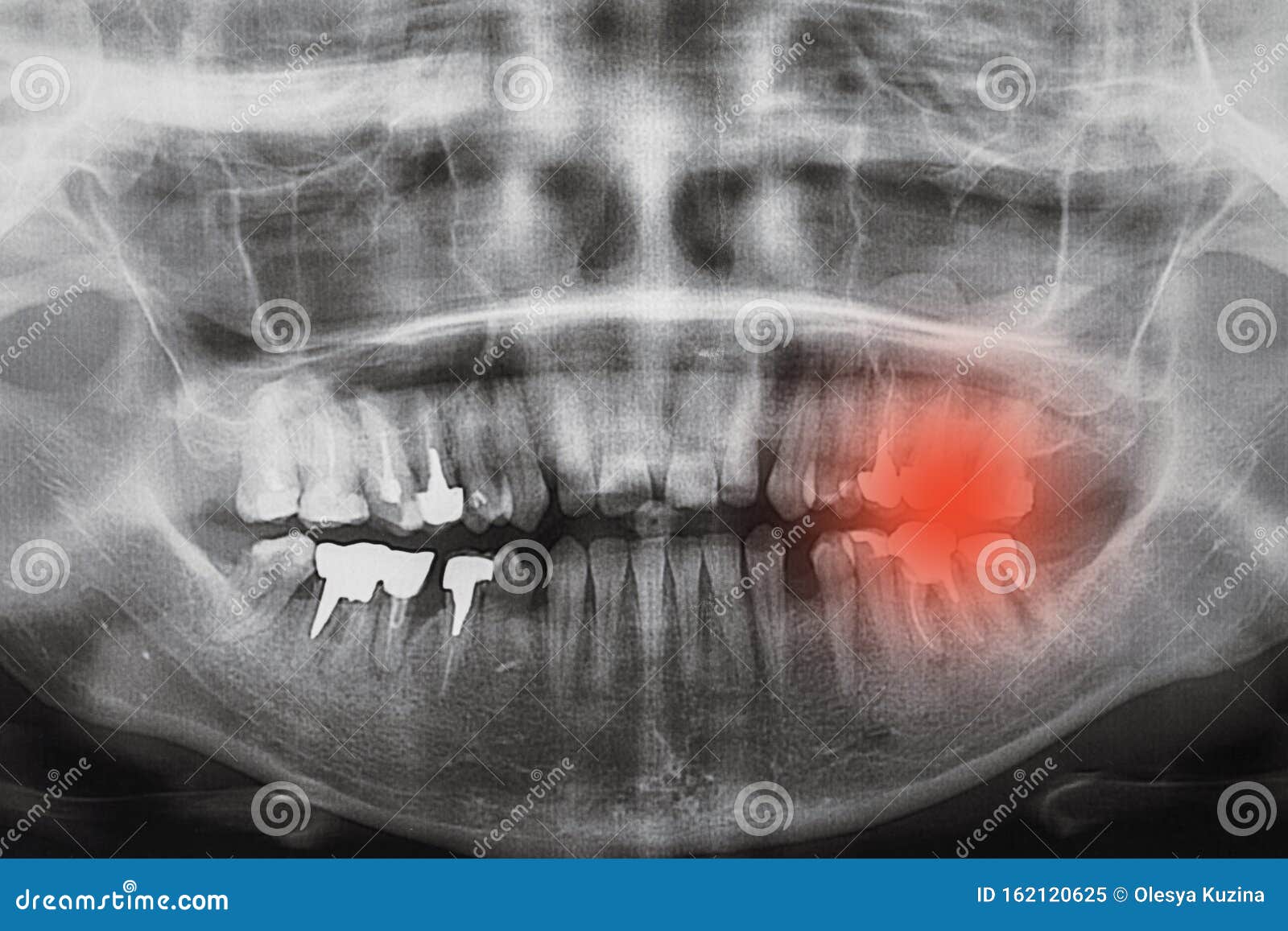 Panoramic X-ray of the Lower and Upper Jaw. Stock Image - Image of ...