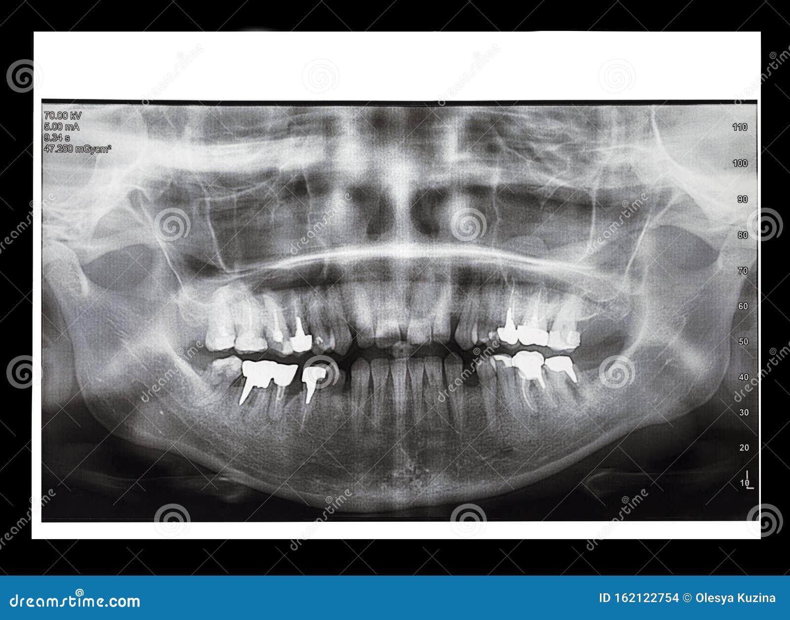Panoramic X-ray of the Lower and Upper Jaw. Stock Photo - Image of ...