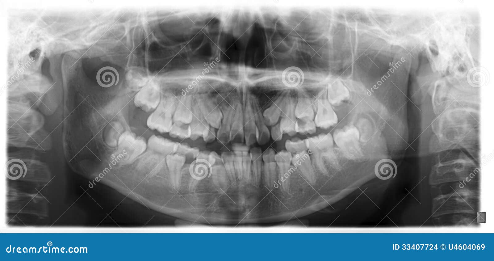 Panoramic X-ray of Mixed Dentition Teeth Stock Photo - Image of canal ...