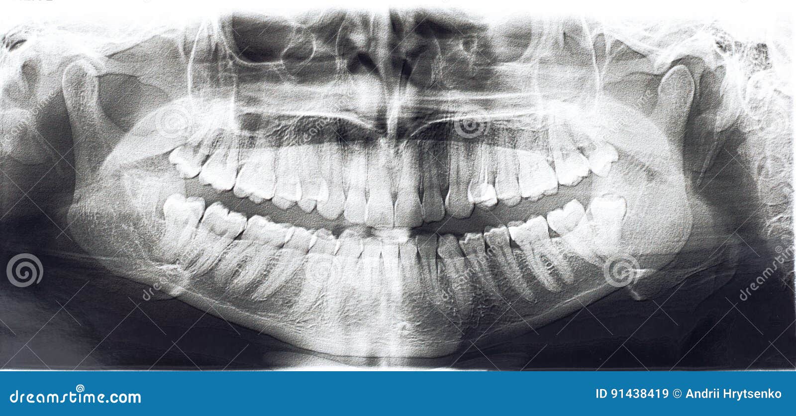 Panoramic x-rays teeth stock image. Image of panoramic - 91438419