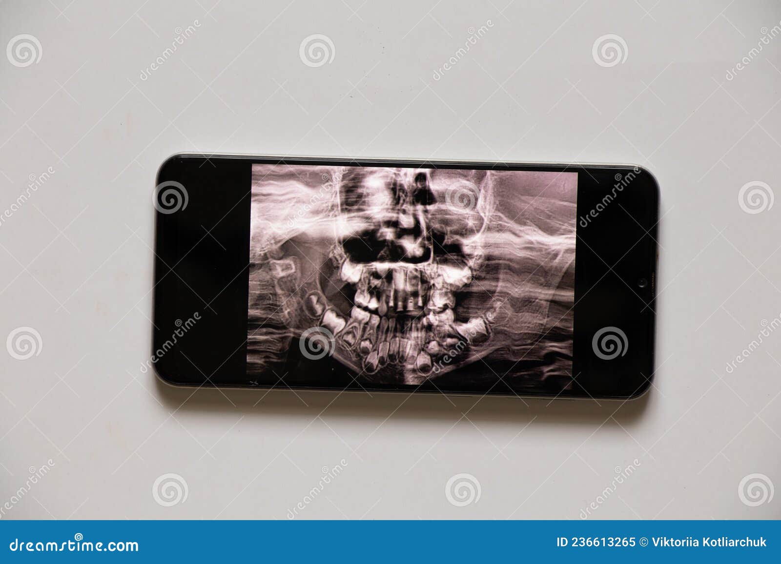 Teeth - Impacted Tooth Cross-section Diagram Stock Image ...