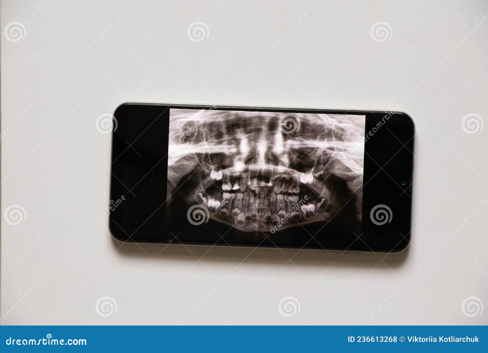 Teeth - Impacted Tooth Cross-section Diagram Stock Image ...