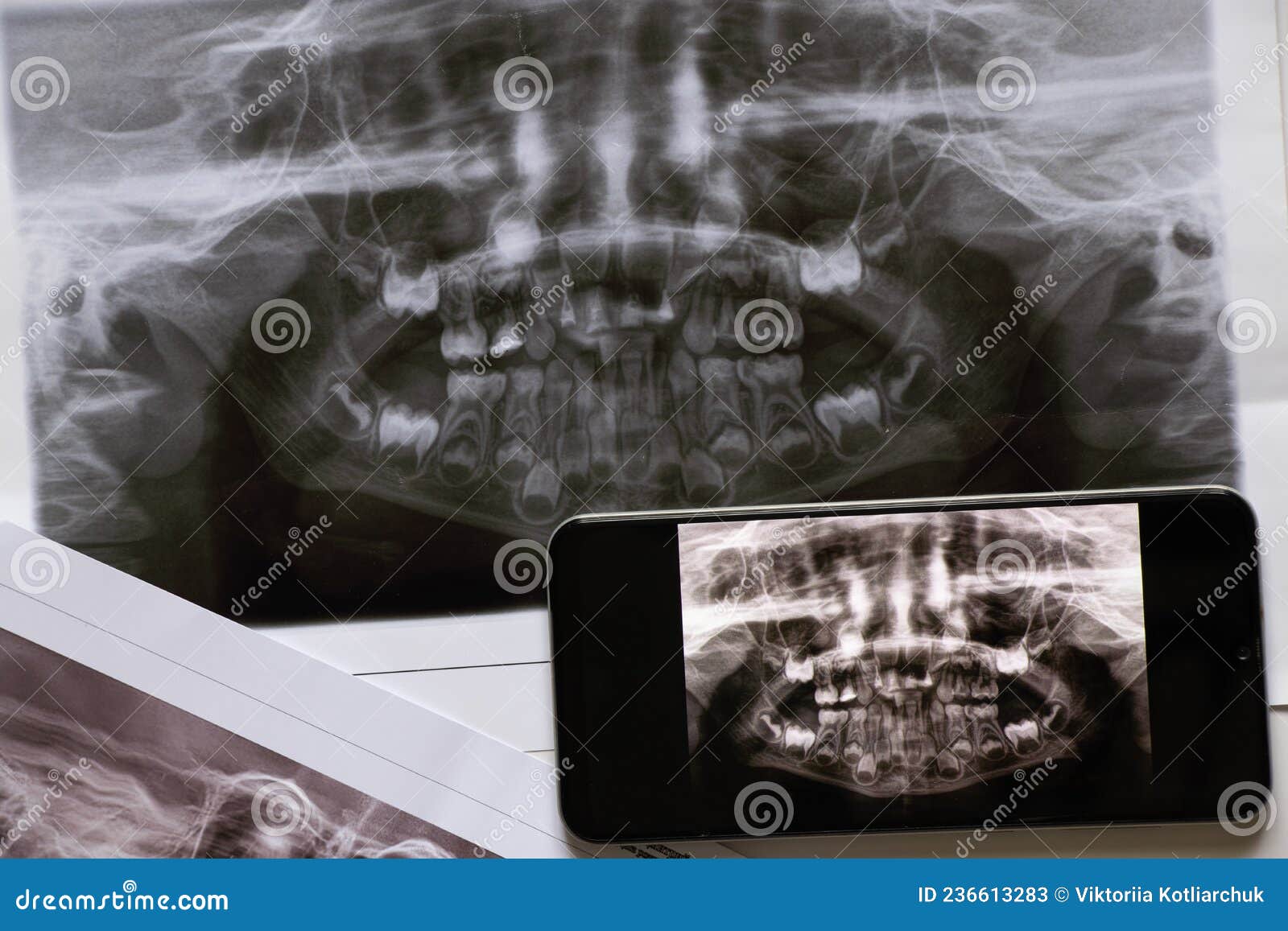 Teeth - Impacted Tooth Cross-section Diagram Stock Image ...