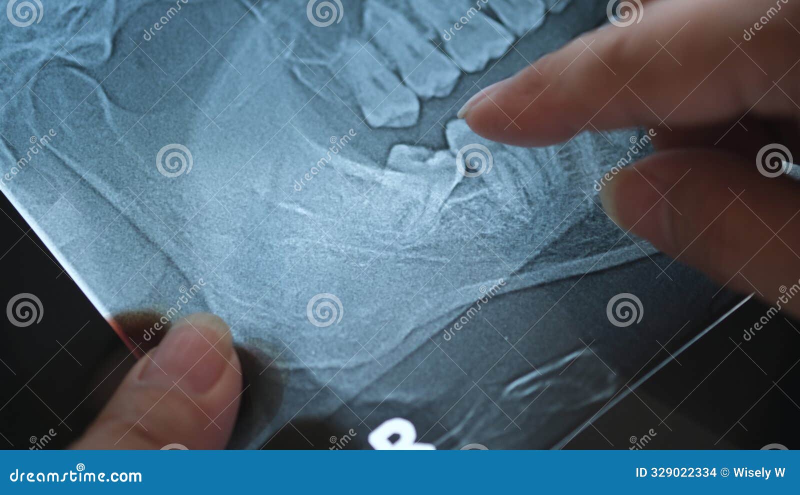Panoramic Xray of Impacted Wisdom Teeth. Stock Photo - Image of human ...