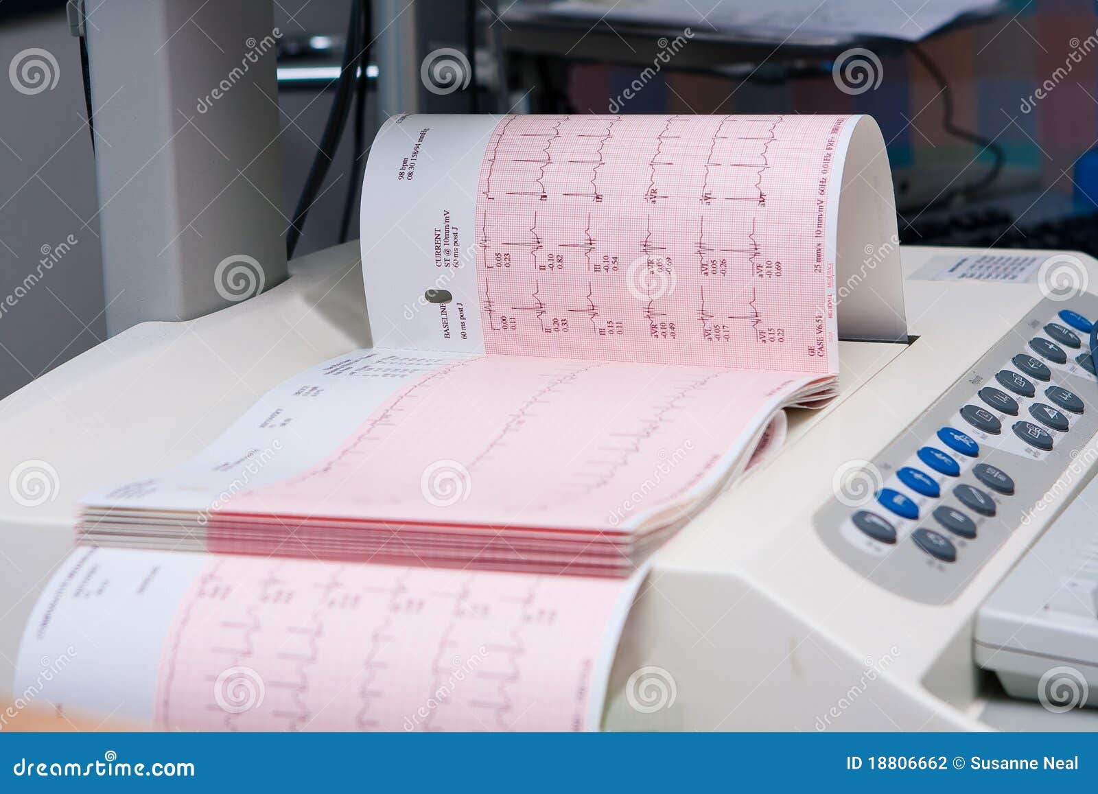 Paper Read-out of Treadmill Test Stock Photo - Image of leads ...