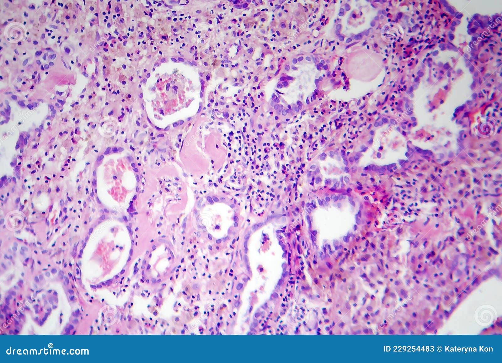 Papillary Thyroid Cancer, Light Micrograph Stock Image - Image of gland ...