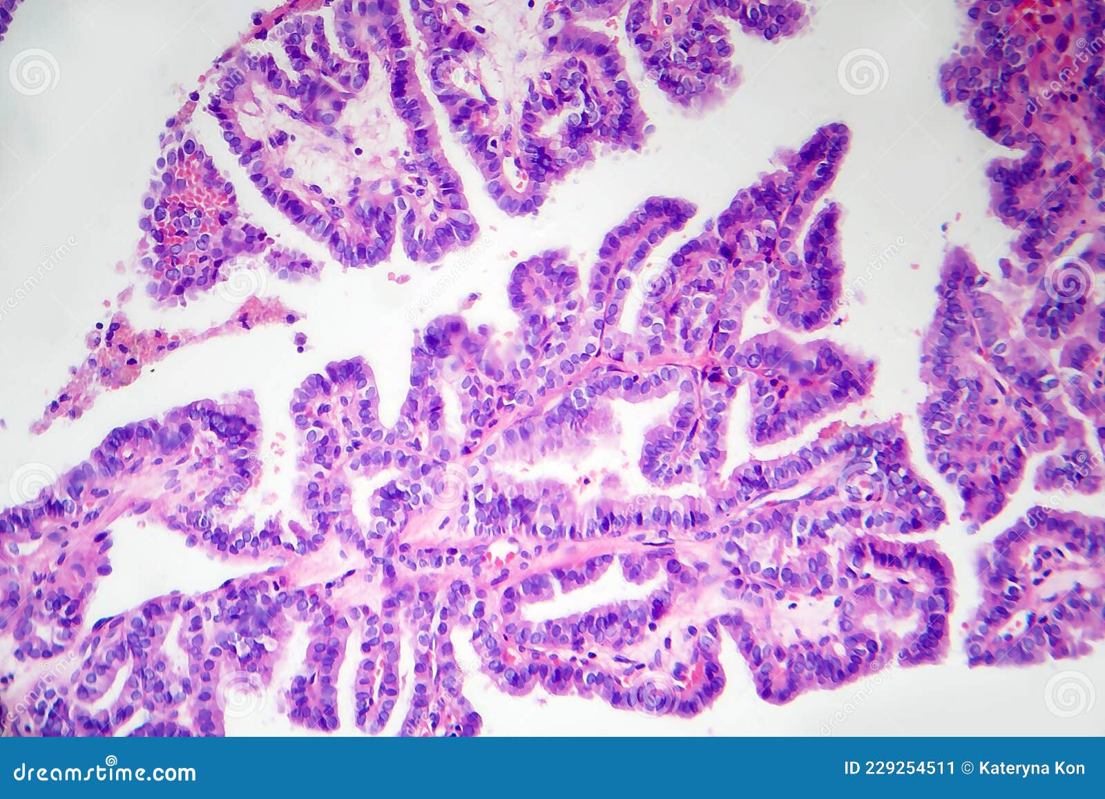 Papillary Thyroid Cancer, Light Micrograph Stock Image - Image of ...