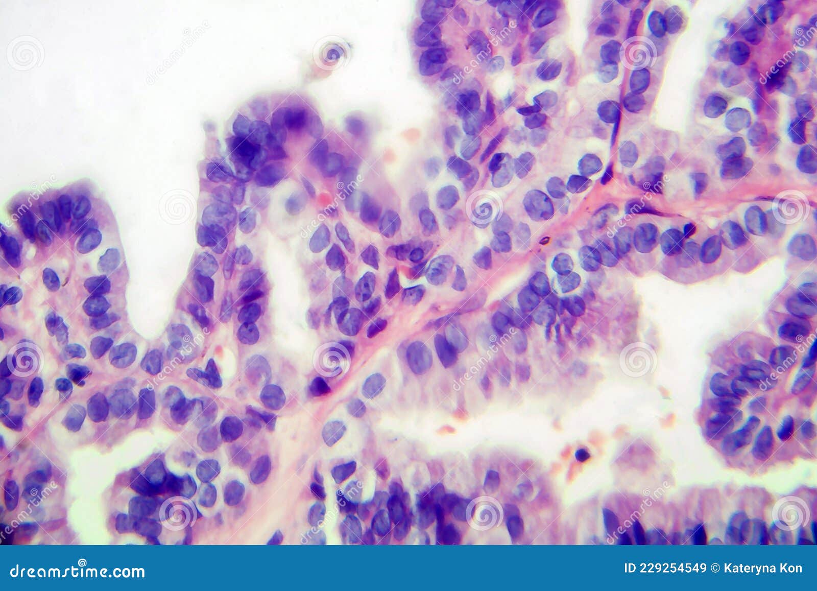 Thyroid Cancer Cells Under Microscope
