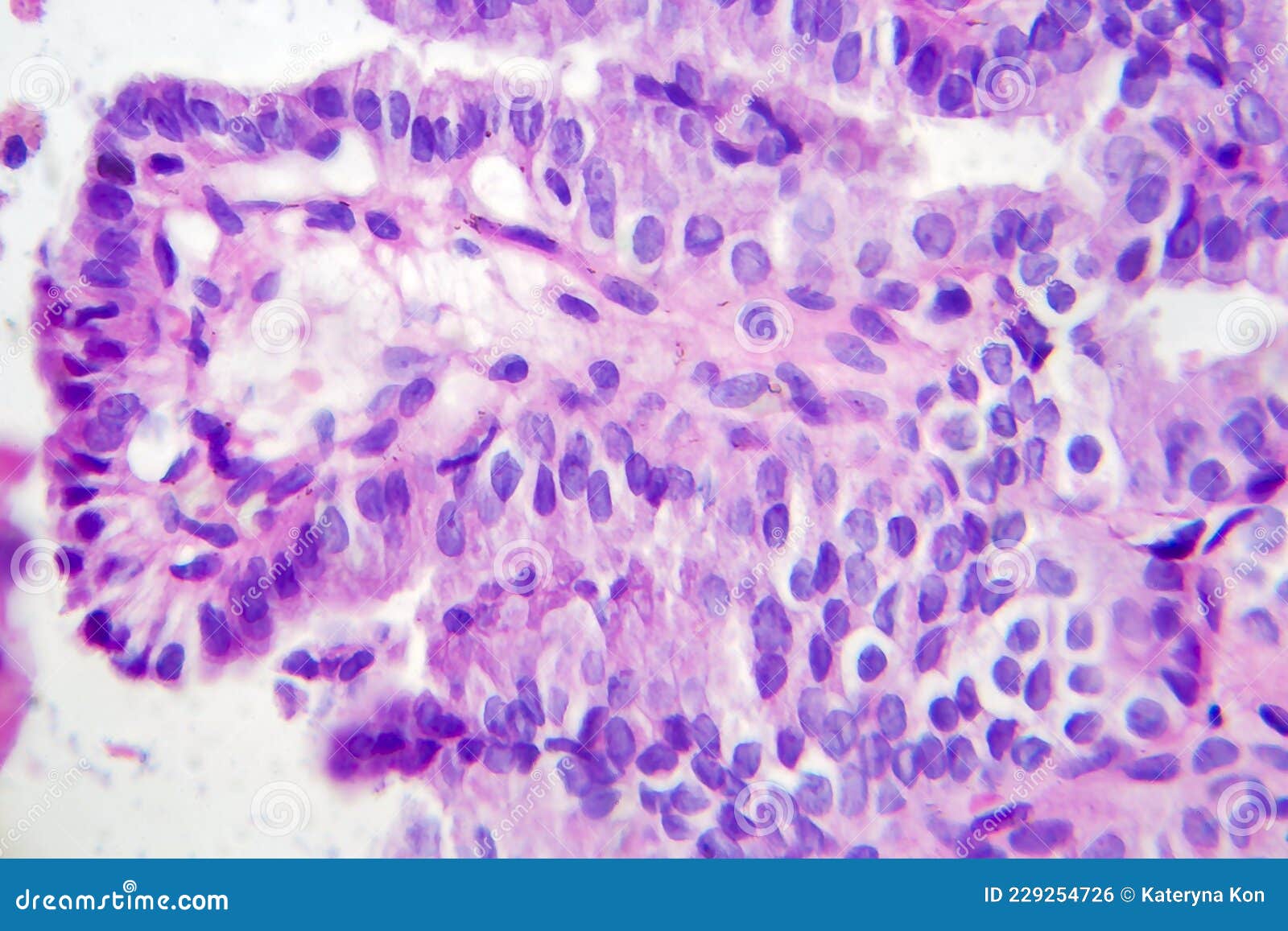 Thyroid Cancer Cells Under Microscope