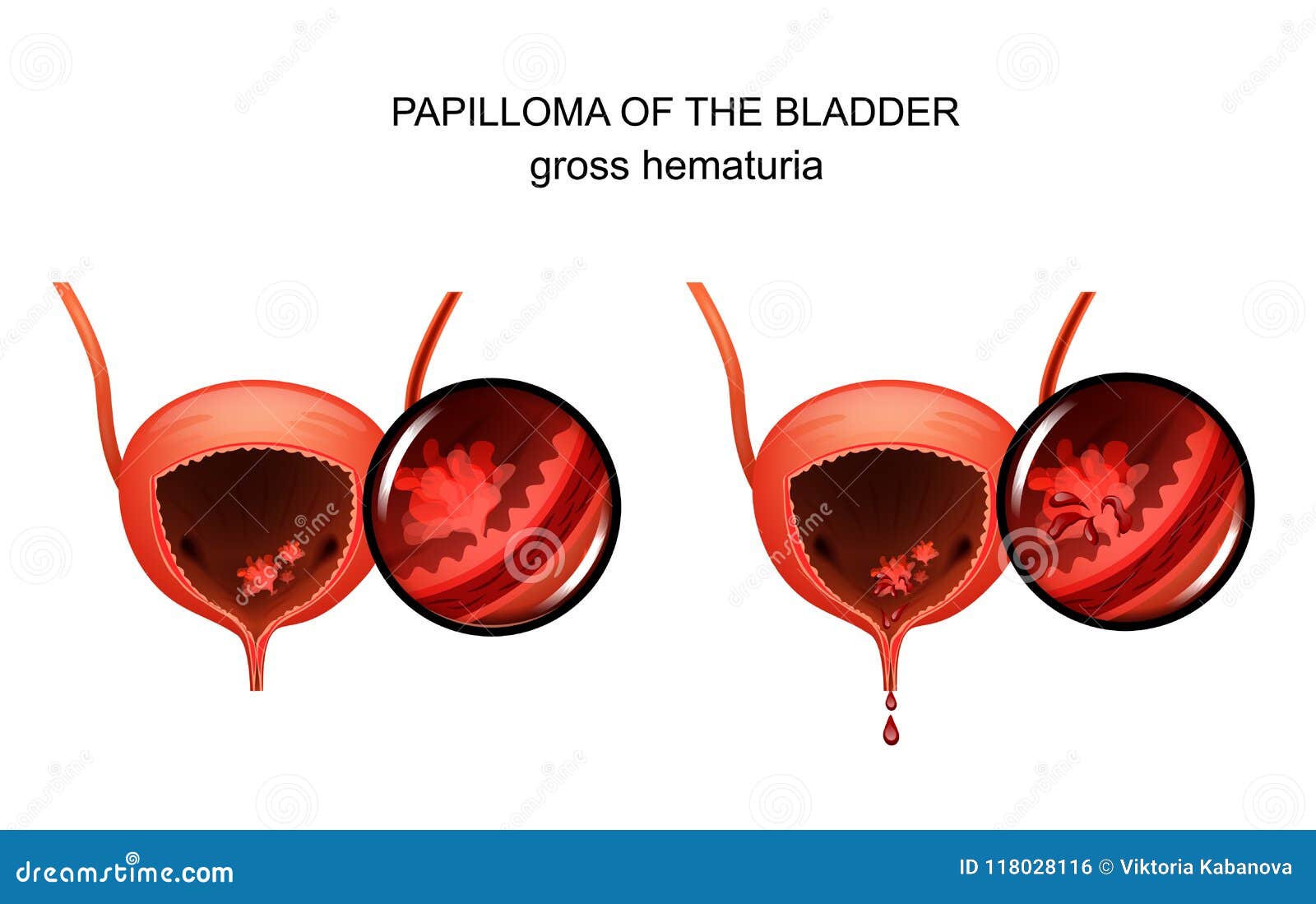 Papilloma in the Urinary Bladder Stock Vector - Illustration of organ ...