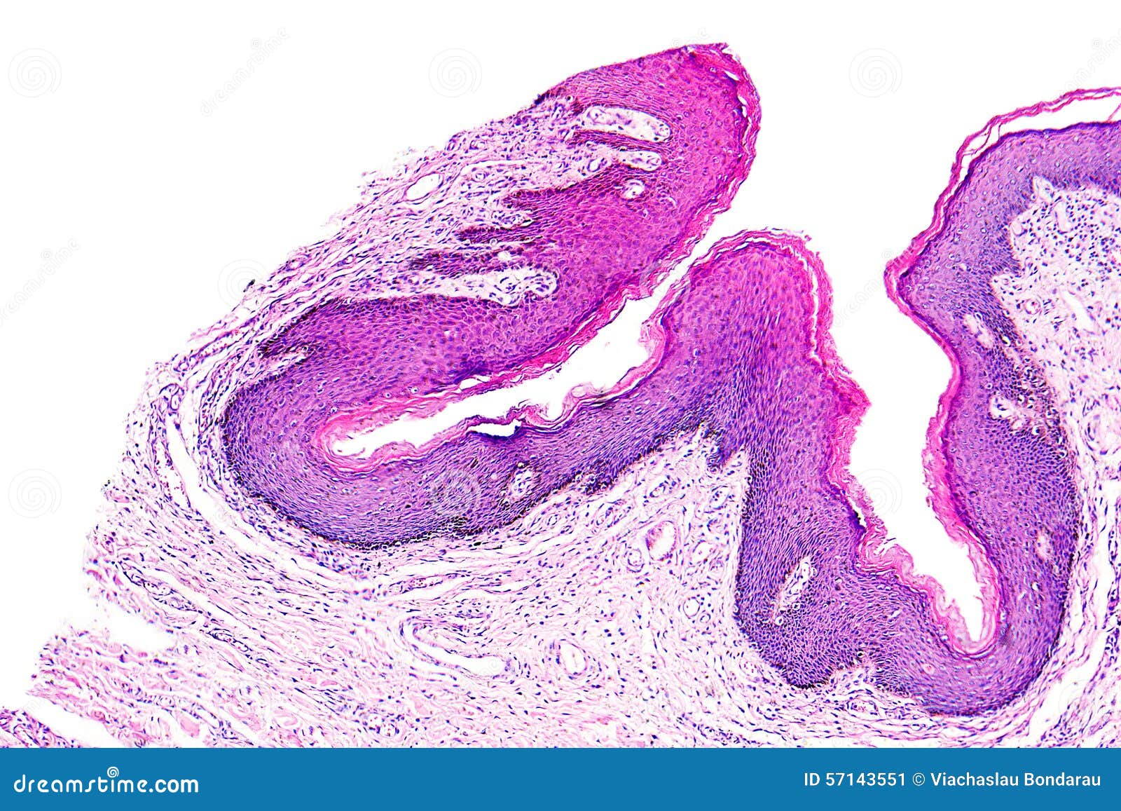 Papillome De Peau D'un Humain Image stock - Image du patient, médical ...