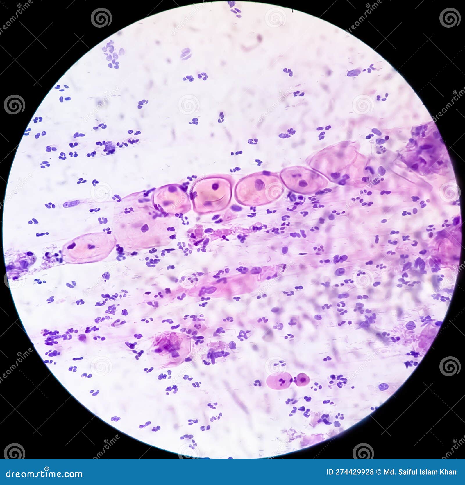 Paps Smear Showing HPV Related Changes. Cervical Cancer. SCC Stock ... Paps Smear Showing HPV Related Changes. Cervical Cancer. SCC Stock ...