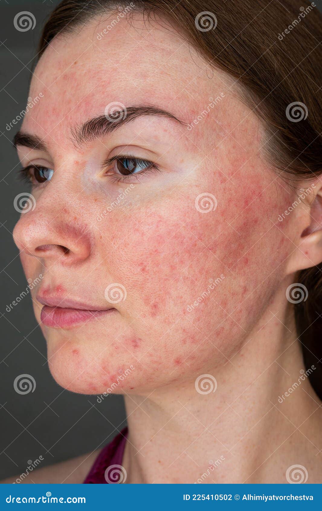 Rosacea Face. The Girl Suffers From Redness On Her Cheeks. Couperosis ...