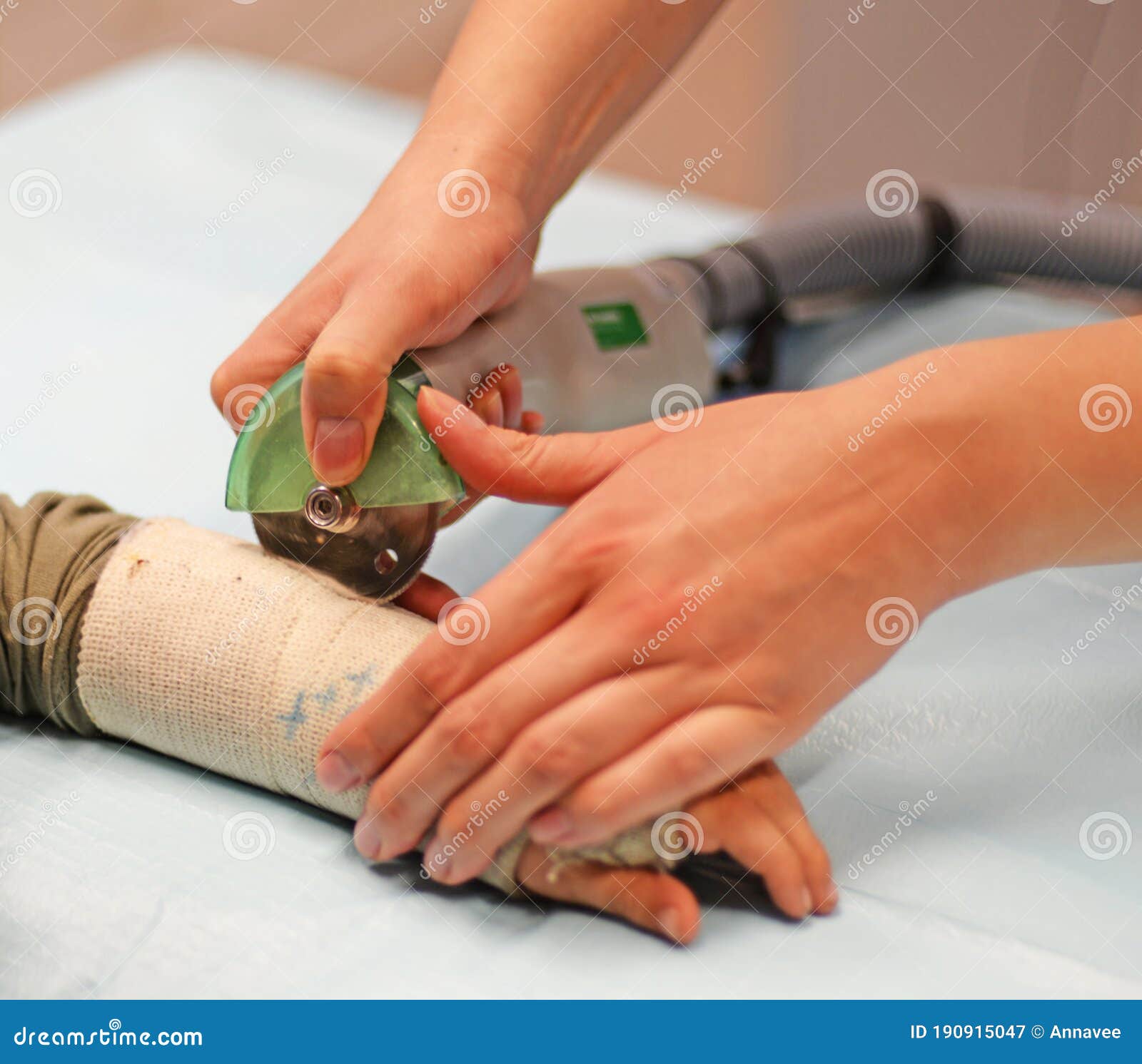 Removing Plaster from Arm with Saw Stock Image - Image of kisses, metal ...