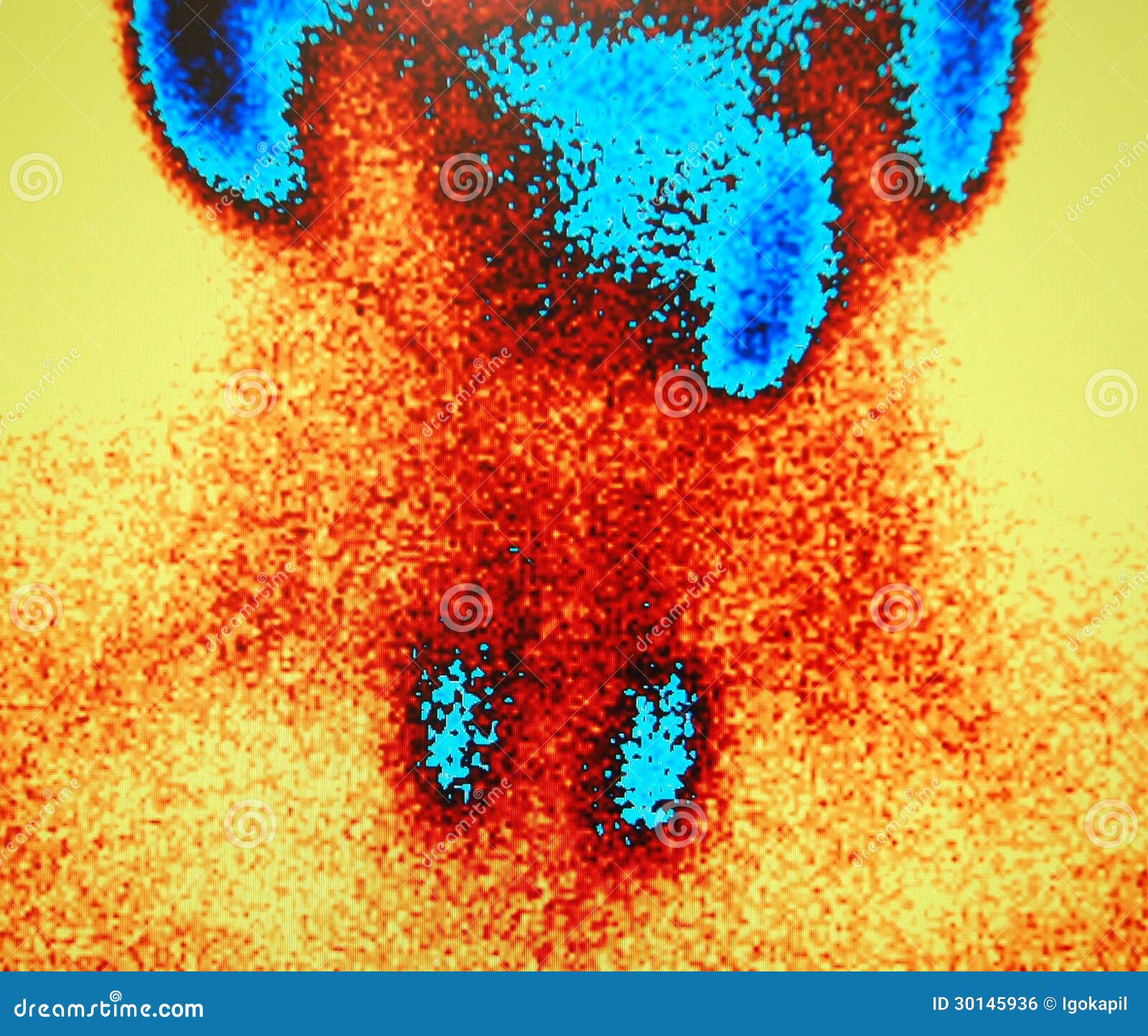 Parathyroid Nuclear Medicine Stock Photo - Image of forums, examination ...