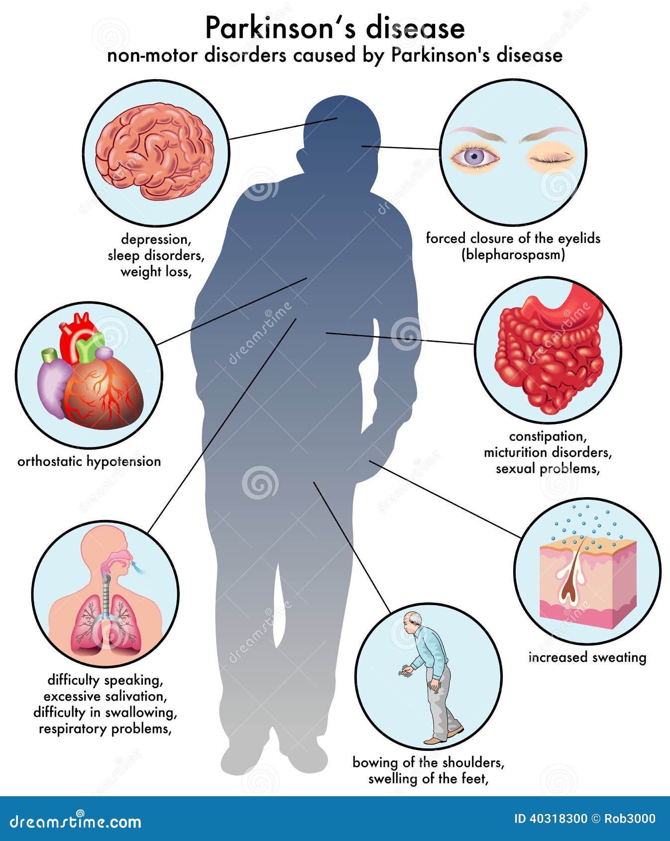 Parkinsons sjukdom vektor illustrationer. Illustration av centralt ...