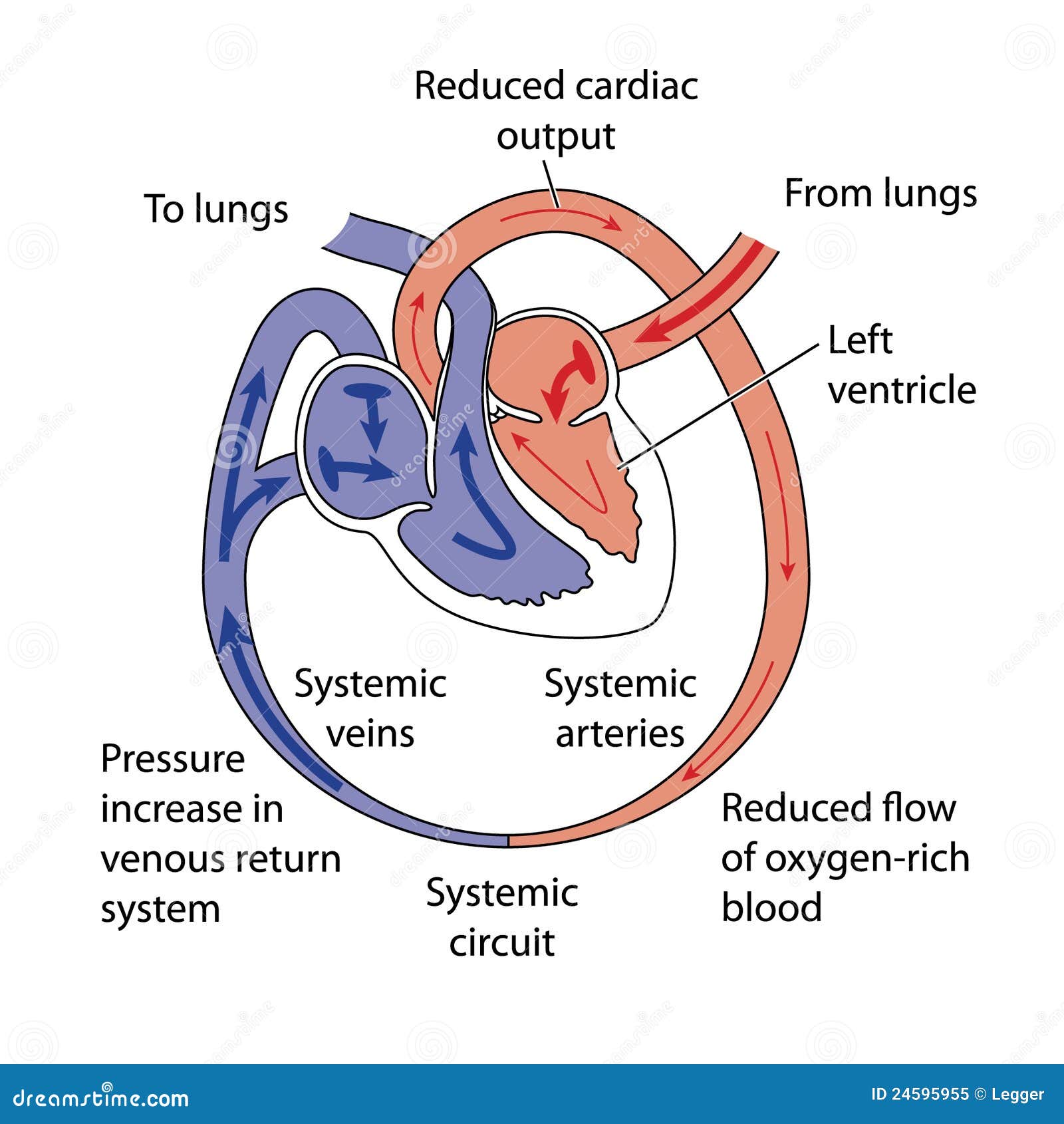 Paro cardíaco ilustración del vector. Ilustración de sistémico - 24595955