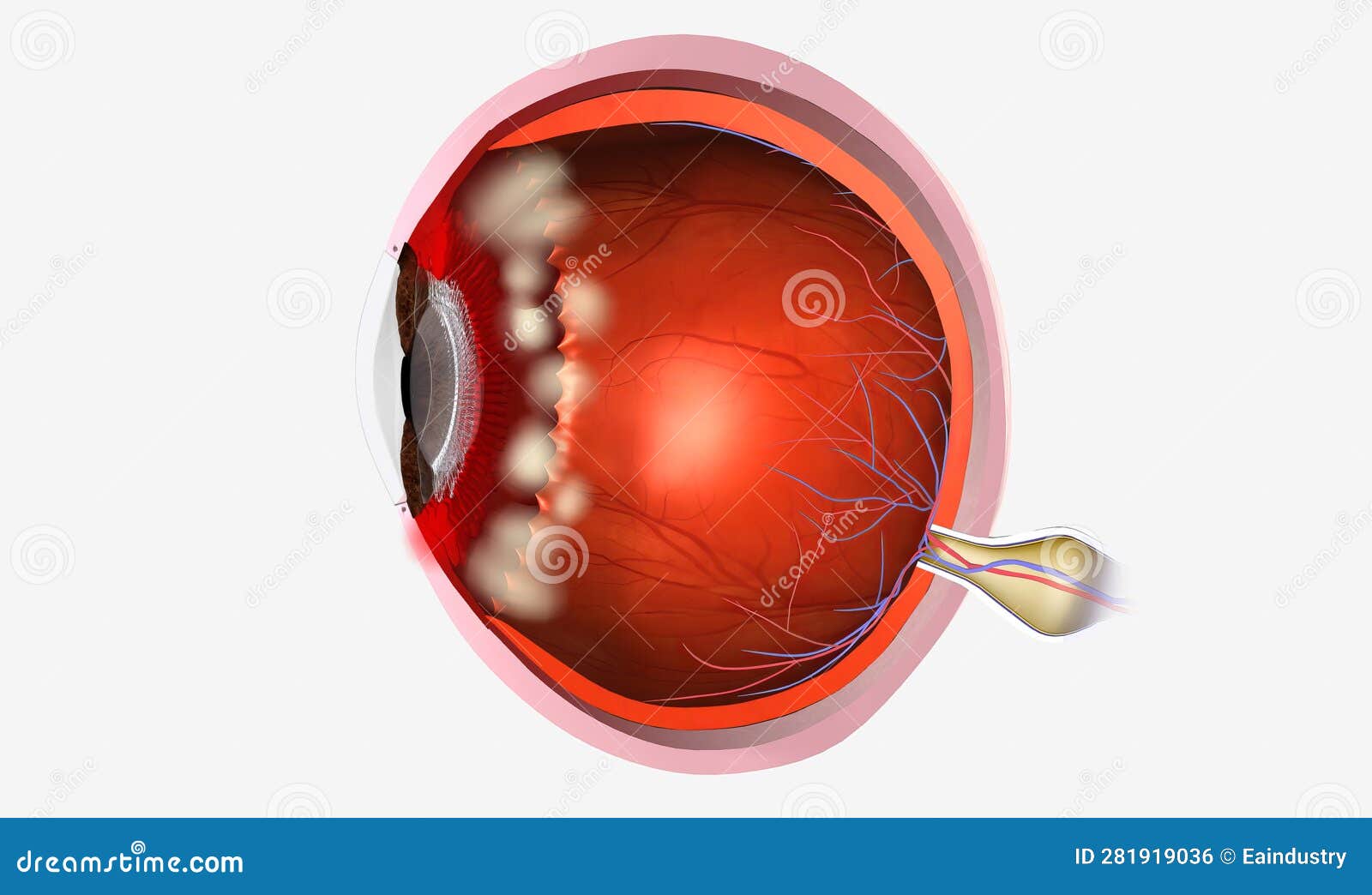Pars Planitis is an Eye Disease Where the Middle Layer of the Eye ...