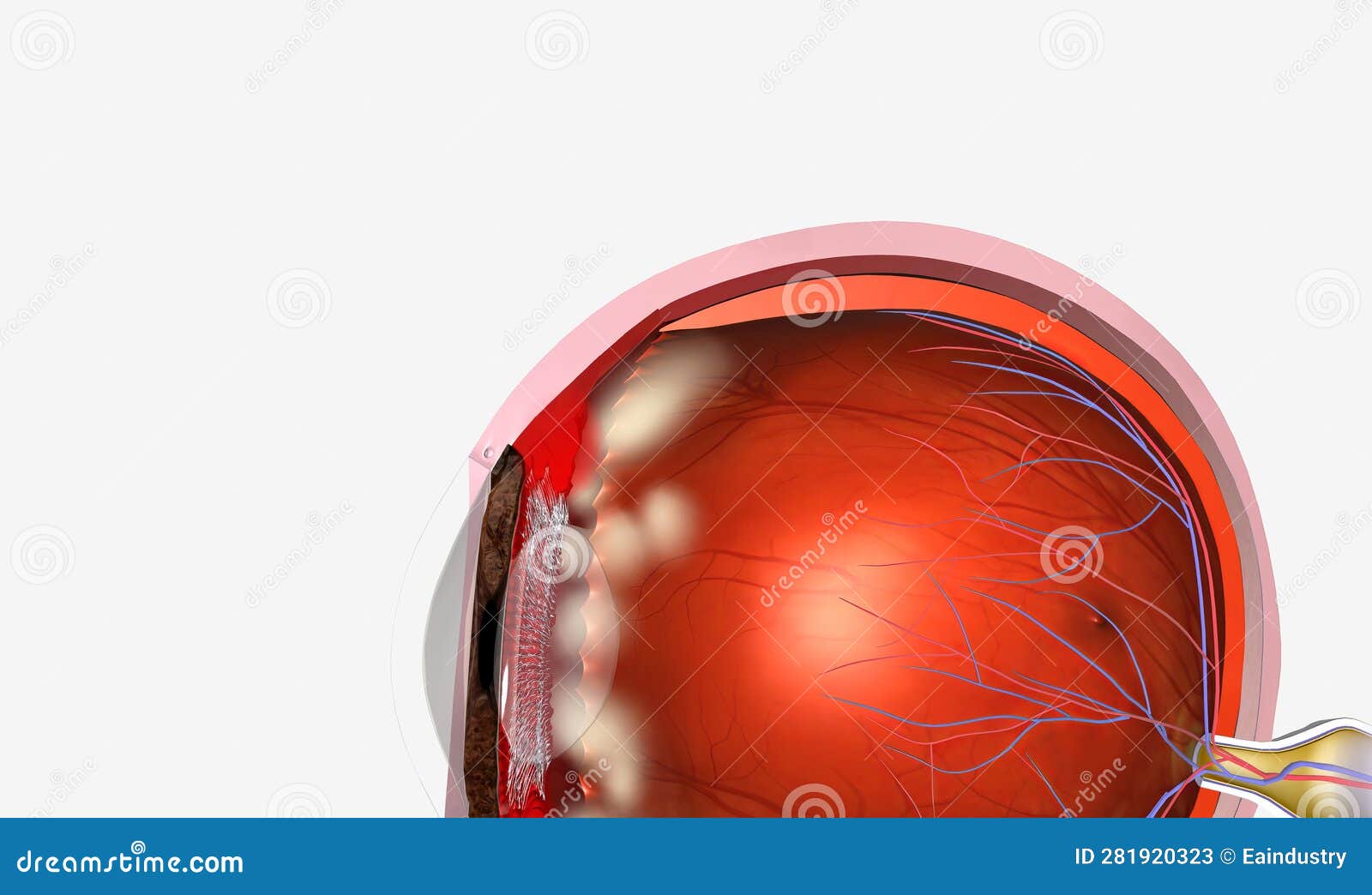 Pars Planitis is an Eye Disease Where the Middle Layer of the Eye ...