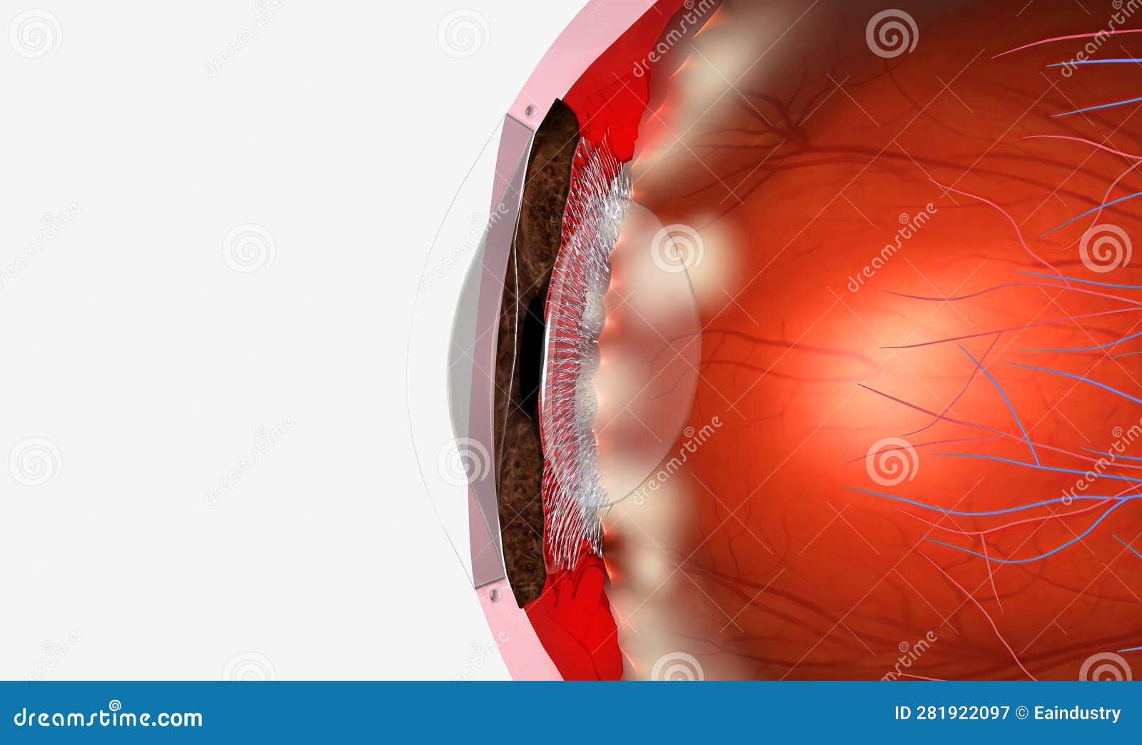 Pars Planitis is an Eye Disease Where the Middle Layer of the Eye ...