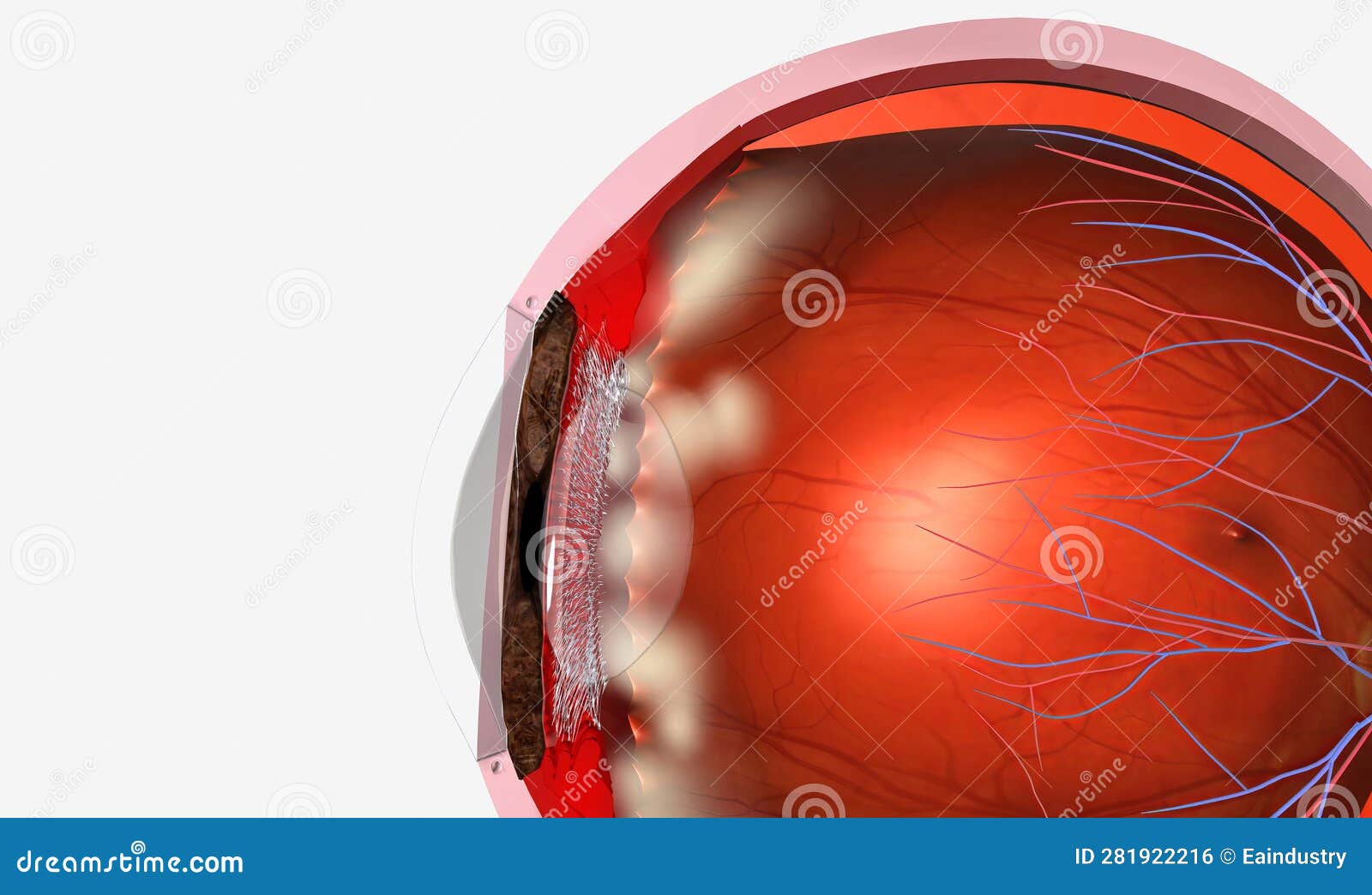 Pars Planitis is an Eye Disease Where the Middle Layer of the Eye ...