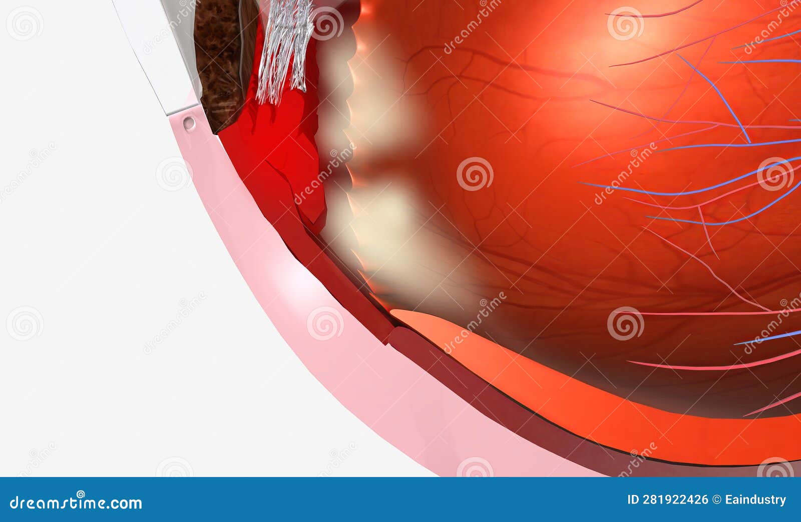 Pars Planitis is an Eye Disease Where the Middle Layer of the Eye ...