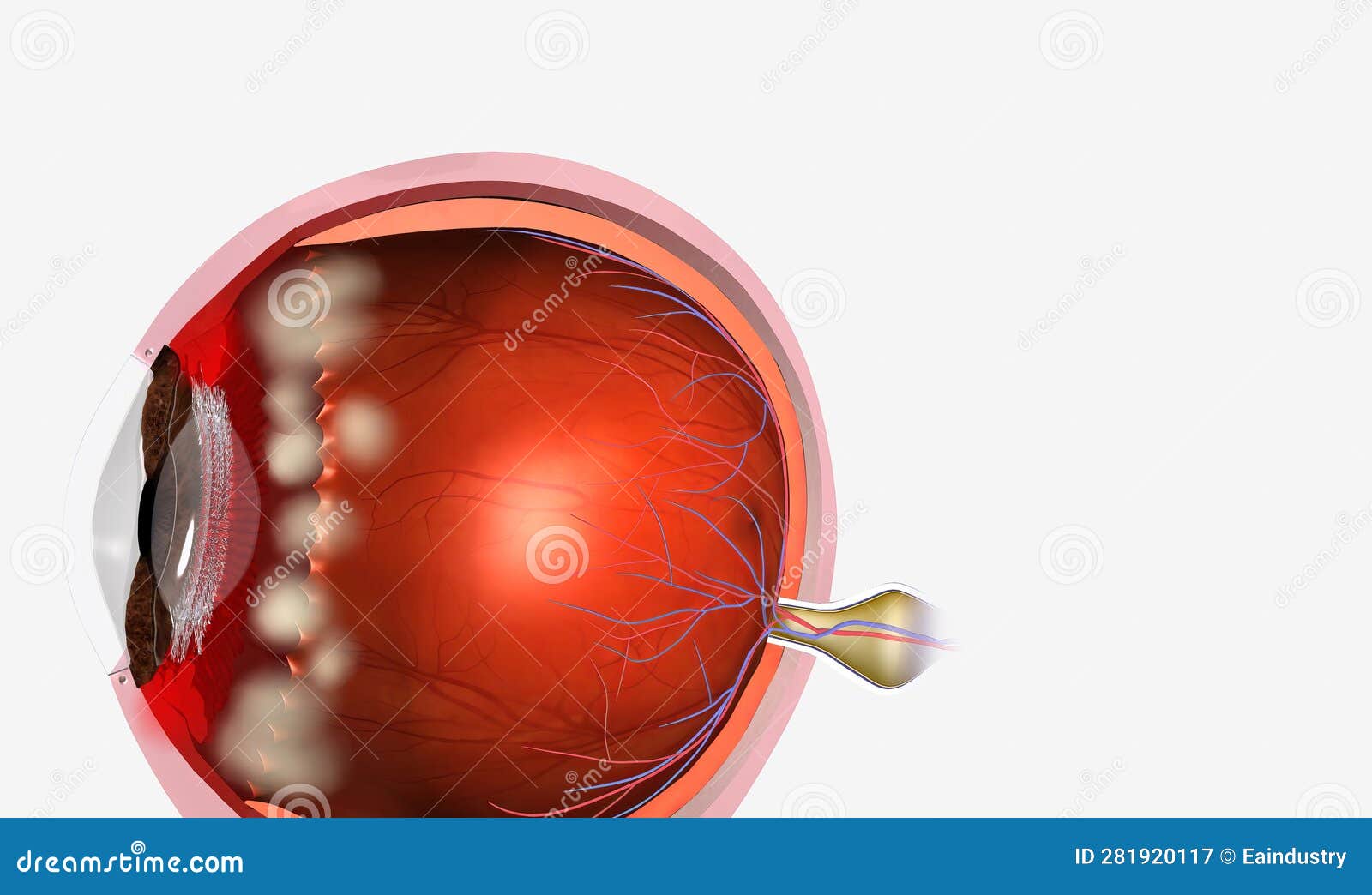 Pars Planitis is an Eye Disease Where the Middle Layer of the Eye ...