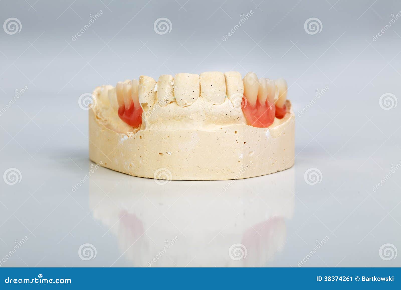 A Partial Denture Mounted on a Plaster Study Model Stock Image - Image ...