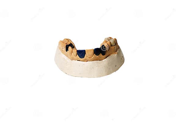 A Partial Denture Mounted on a Plaster Study Model Stock Photo - Image ...