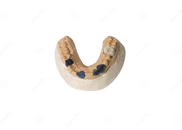 A Partial Denture Mounted on a Plaster Study Model Stock Photo - Image ...