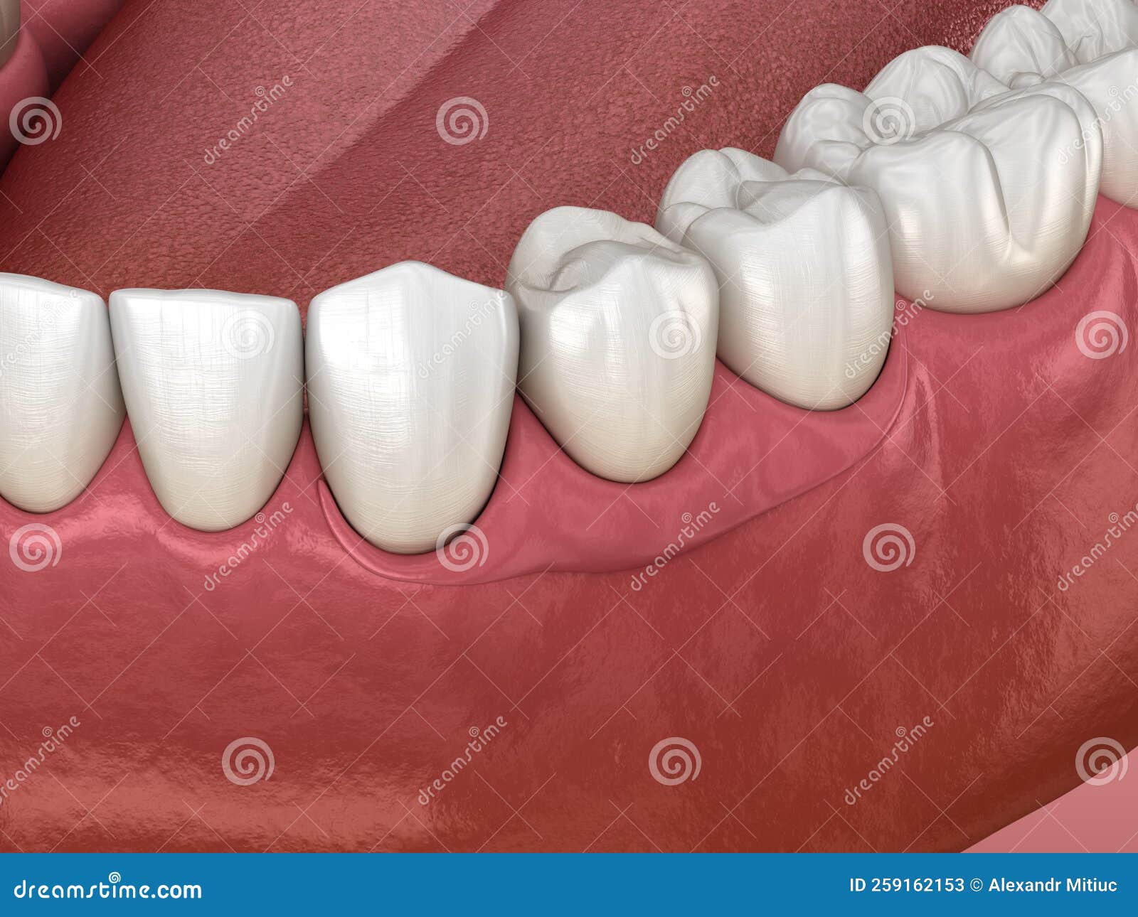 Partial Removable Immediate-denture Type Butterfly. Replacement of One ...