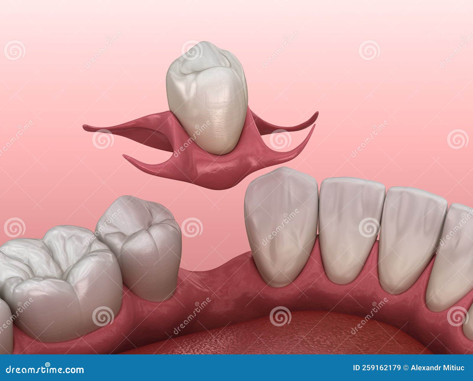 Partial Removable Immediate-denture Type Butterfly. Replacement of One ...