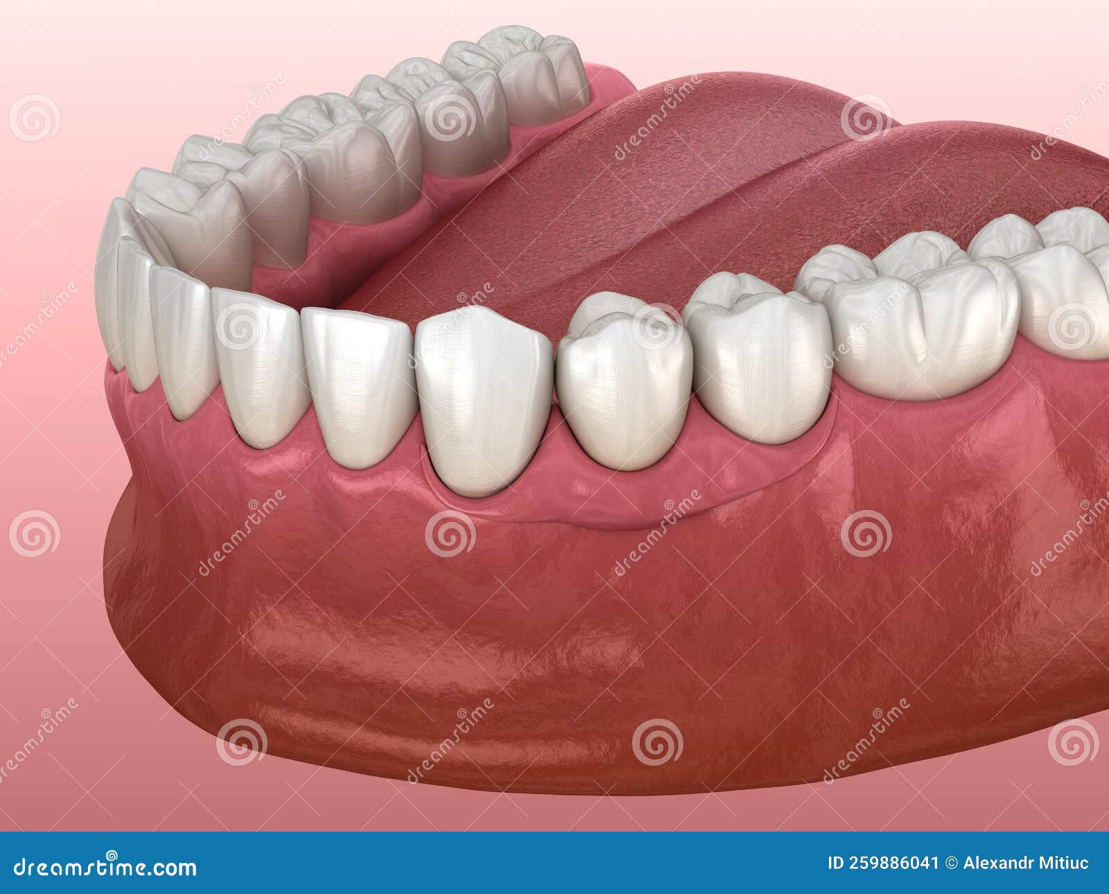 Partial Removable Immediate-denture Type Butterfly. Replacement Of One ...