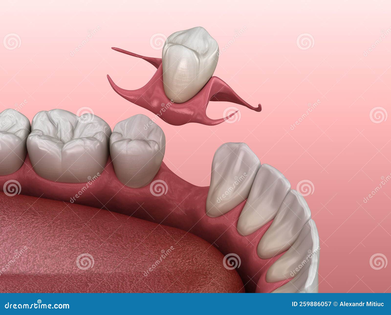 Partial Removable Immediate-denture Type Butterfly. Replacement Of One ...