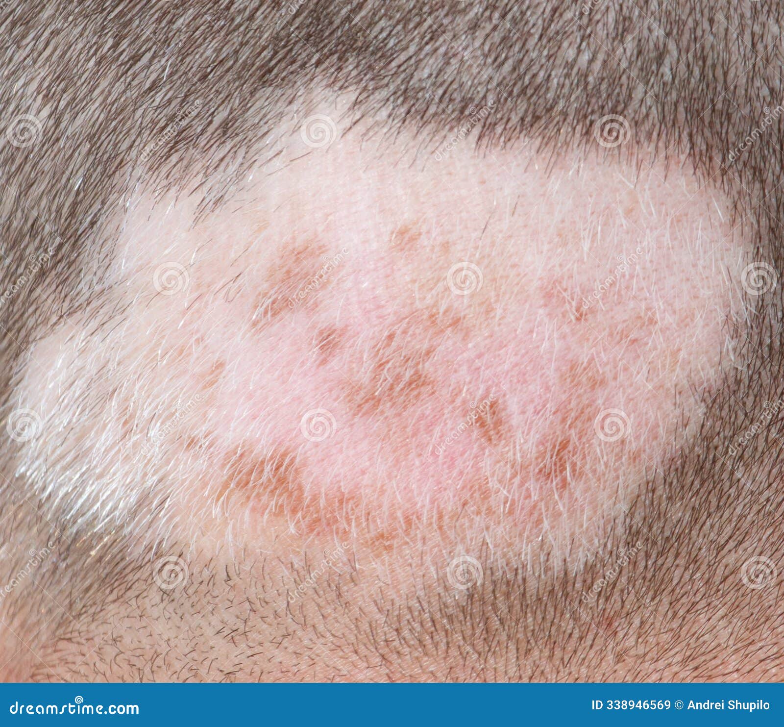 A Patch of Skin with a Red Mark on it Stock Image - Image of healthcare ...