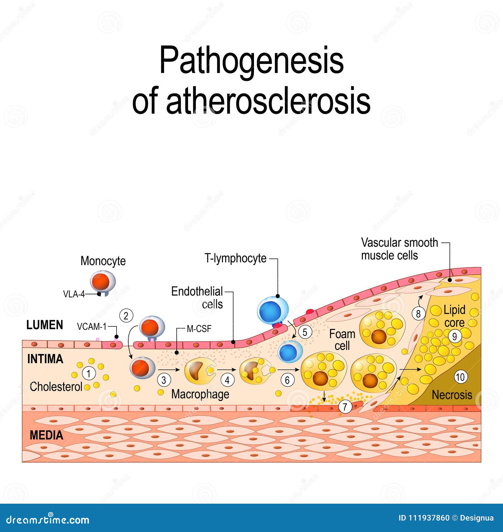 Pathogenese Van Atherosclerose Vector Illustratie - Illustration of ...