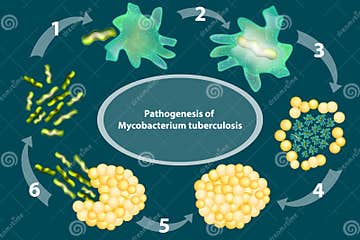 Pathogenesis of Mycobacterium Tuberculosis. Stock Vector - Illustration ...