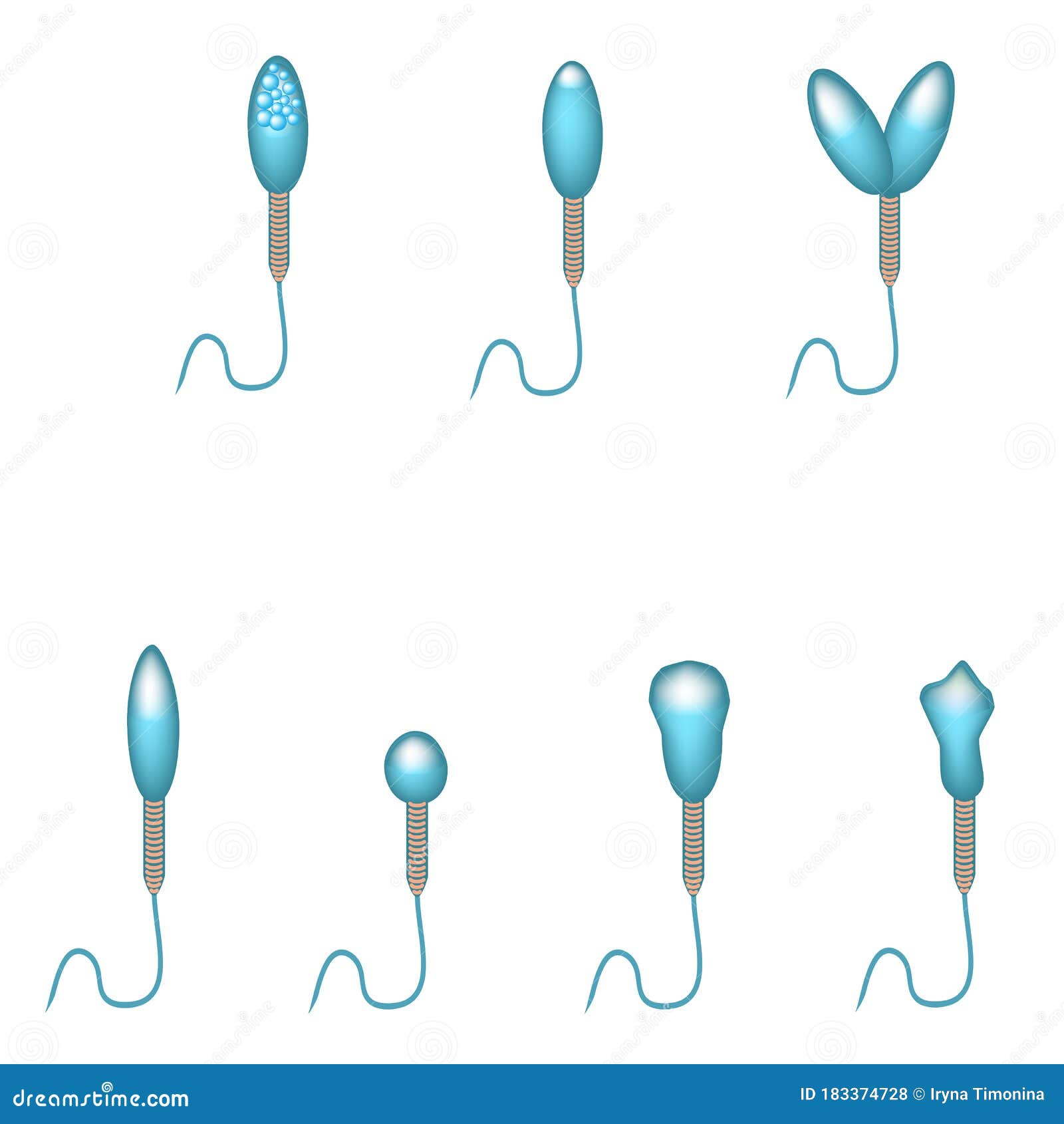 Pathological Forms of Sperm in the Ejaculate. Male Infertility ...