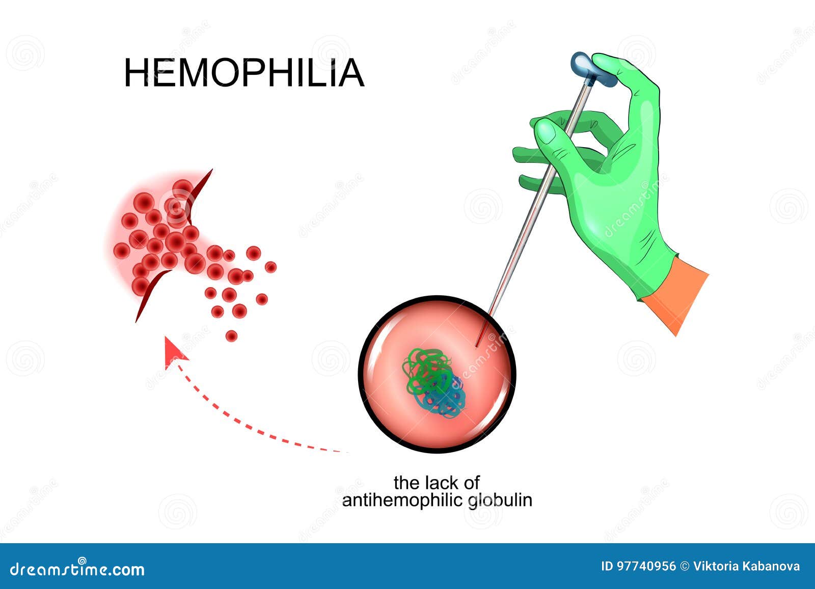 The Pathological Process in Hemophilia Stock Vector - Illustration of ...