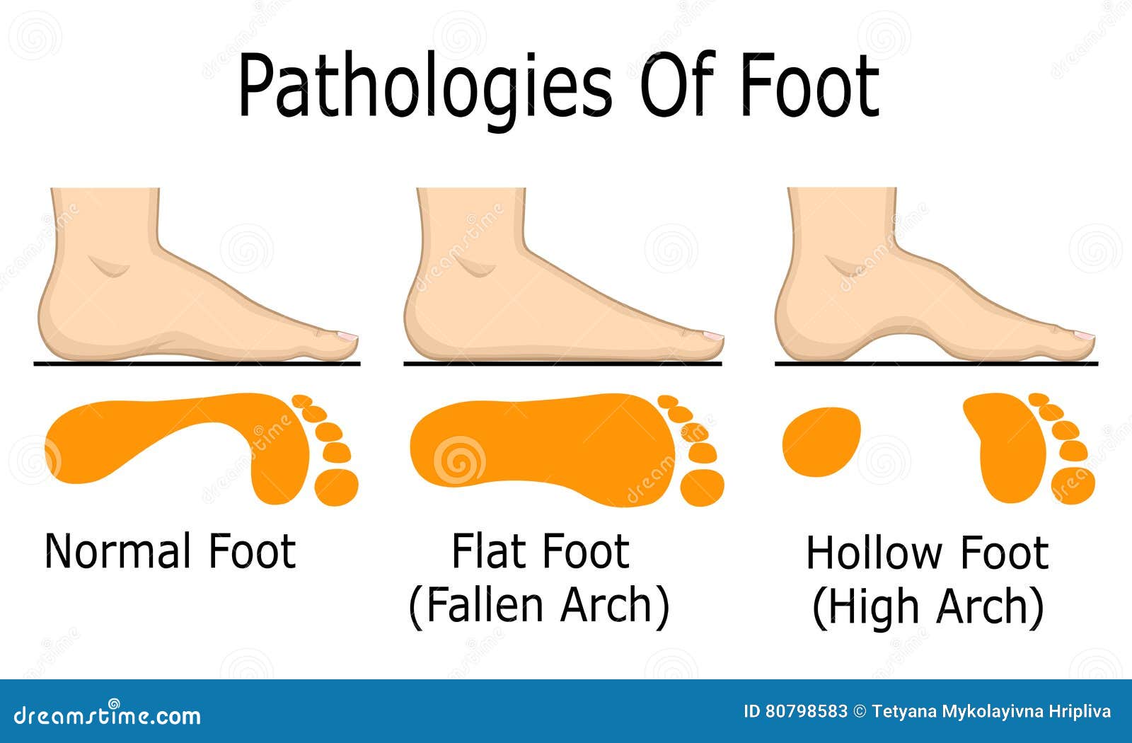 Foot With Pathologies. Fungal Lesions Of The Foot, Nails And Skin ...