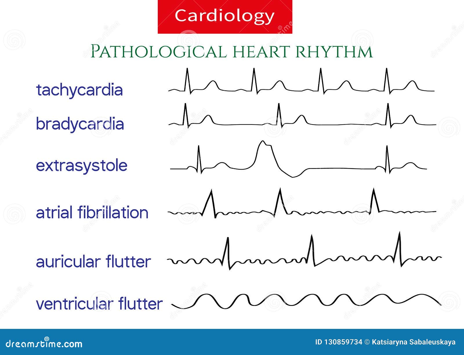 Pathologische ecg Sammlung stock abbildung. Illustration von pappe ...