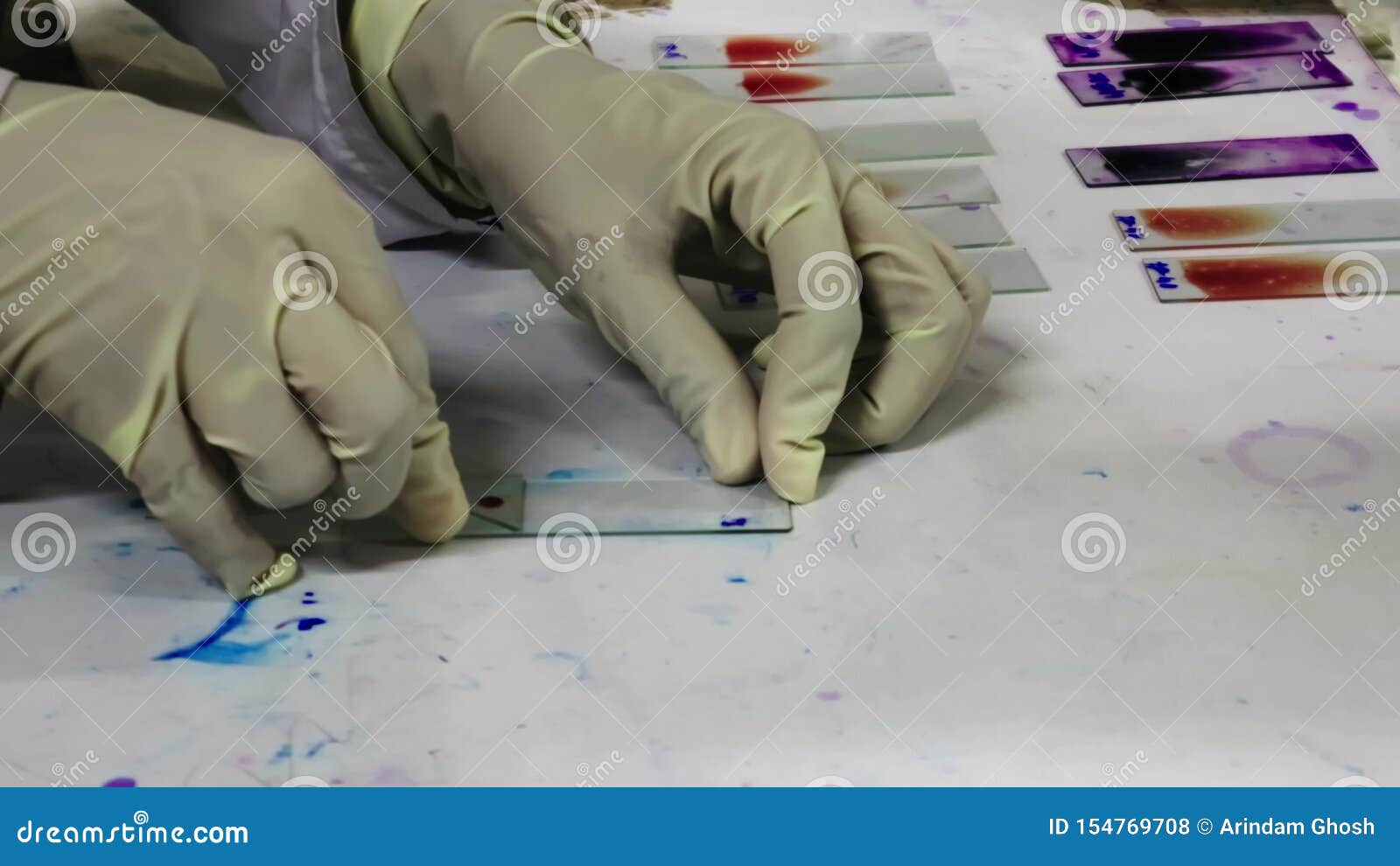 A Pathologist Gloved Hand Draws a Blood Smear on a Glass Slide Stock ...