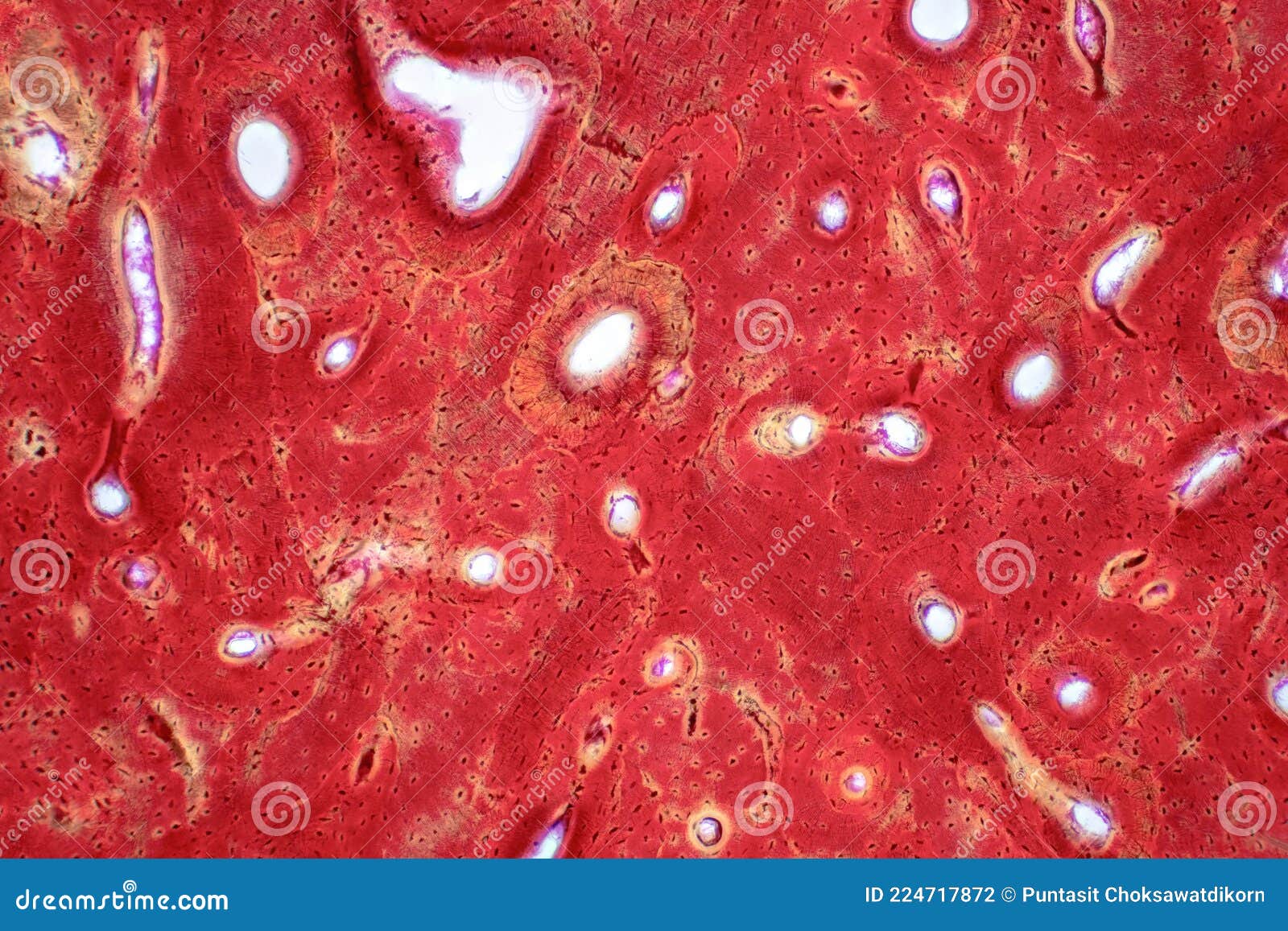 Pathology of Human Compact Bone Tissue Under Light Microscope View ...
