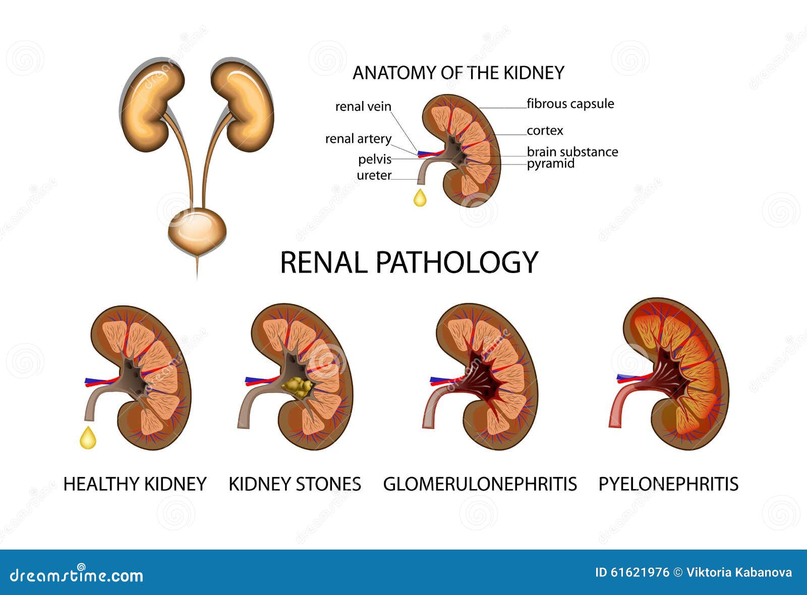 Pathology Of The Kidneys. Stock Vector - Image: 61621976